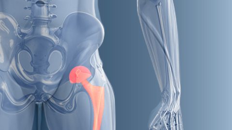 Hüft-TEP | MedAthlon